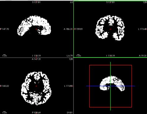 issue with brain segmentation image after using imagemath · issue 1510