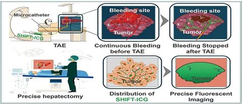 Regbio速递 超稳定均质碘油icg配方用于肝癌破裂出血急诊栓塞止血与后续荧光导航精准肝切除的可行性探索和首次临床应用 厦门宏谱福生物