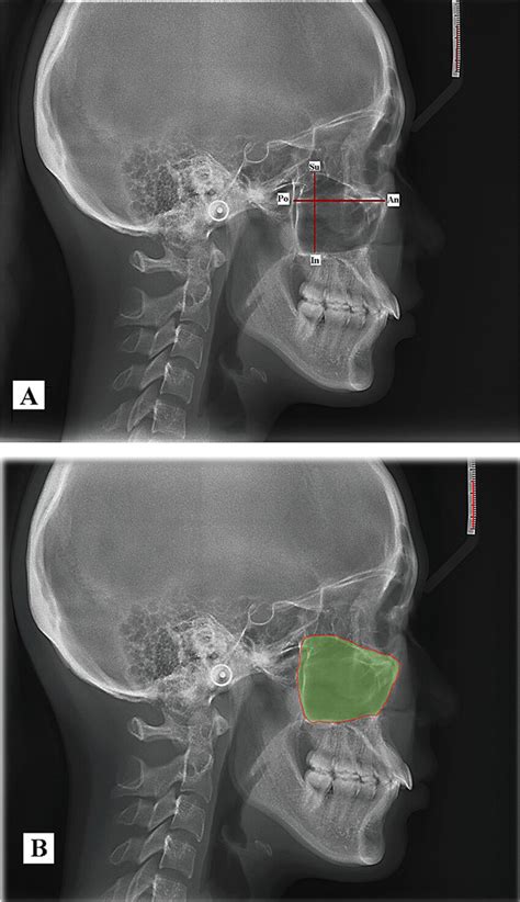 The Maxillary Sinus Indices Assessment A Length And Height Of The Download Scientific Diagram