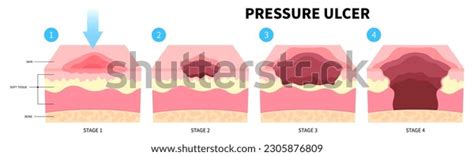 Canker Sore Diagram
