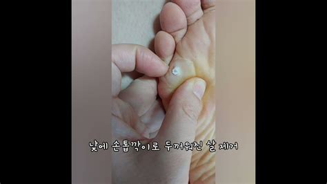 발바닥 사마귀 셀프치료 과정 간단해요 Youtube