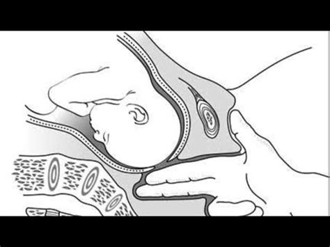 Vaginal Exam In Labor What Do We Do Youtube