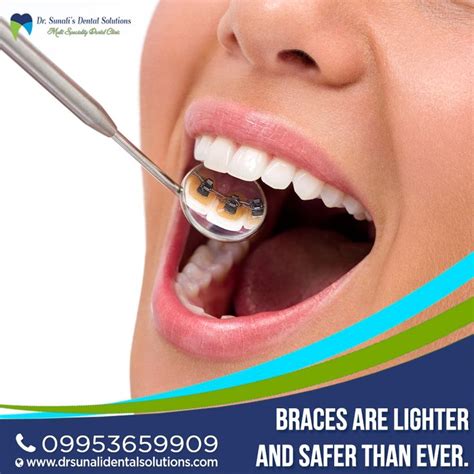 A Perfectly Straight And Aligned Teeth Will Not Be A Dream Any More