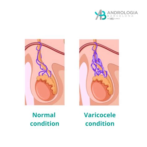 Varicocele Ultrasound Procedure Varicocele Central Ohio Urology
