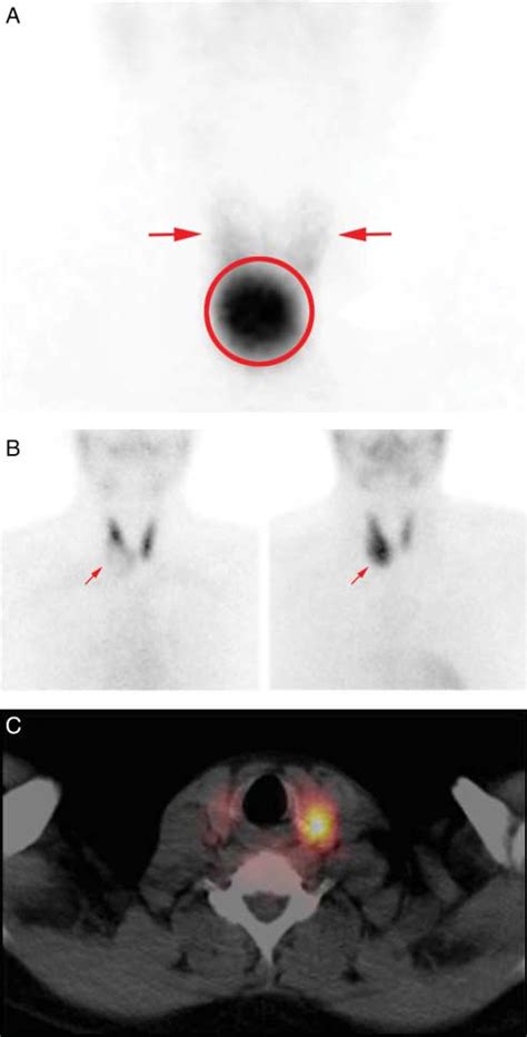 A 99m Tc Pertechnetate Thyroid Scan Autonomous Thyroid Nodule Red