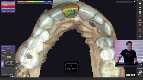 Exocad Level 1 Foundations The Mod Institute