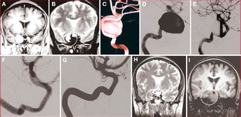 A 58 Year Old Woman With A Giant Right Cavernous Segment Internal Download Scientific Diagram