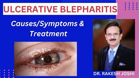 Ulcerative Blepharitis Treatment