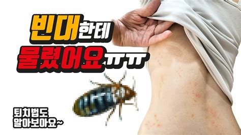 진드기 제거방법과 청결방어 진드기or빈대 70군데 물렸어요 Youtube