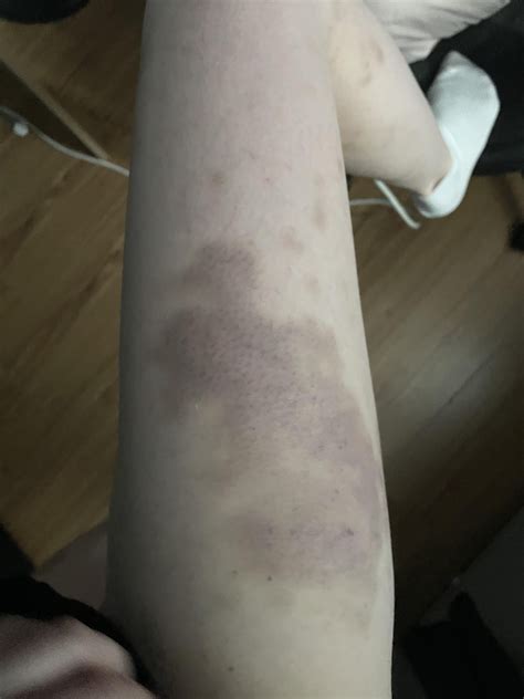 Update On Unexplained Bruising R Diagnoseme