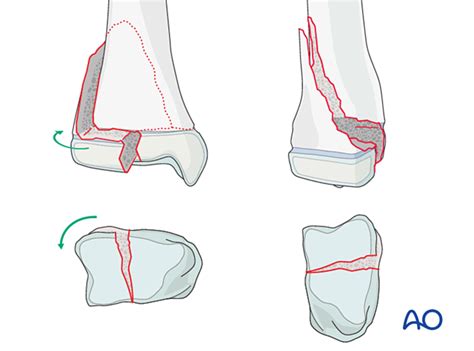 Complex Epi Metaphyseal Fractures Of The Distal Tibia Triplane Complex Epi Metaphyseal Fractures Of The Distal Tibia Triplane