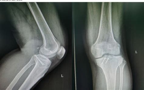 Figure 1 From Treatment Of Tibia Avulsion Fracture Of Posterior