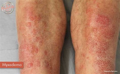 Effects Of Hyperthyroidism On Skin