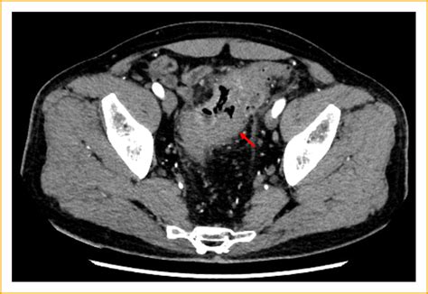 An Unusual Case Of Diverticulitis Protruding Into Sigmoid Colon The American Journal Of The