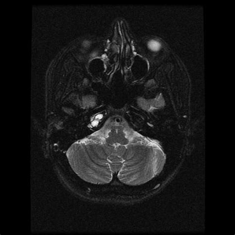 Cholesterol Granuloma Radiology At Nilsa Sutton Blog