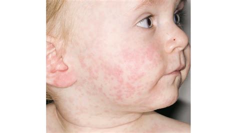 Teething Rash On Body Renew Physical Therapy