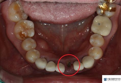 서울유플란트 원데이 앞니 임플란트 치료 사례 Feat 아래 앞니가 부러졌어요 네이버 블로그