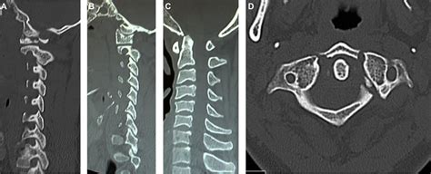 Reliability Of The New Aospine Classification System For Upp Neurosurgery Reliability Of The New Aospine Classification System For Upp Neurosurgery