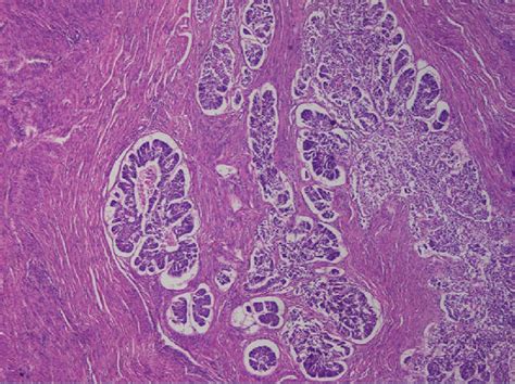 H And E Stain Showing Moderately Pleomorphic Tumor Cells Arranged In