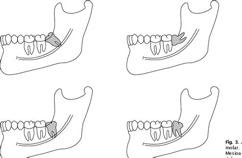 Figure 3 From A Correlation Between Mandibular Angle Fracture And The Mandibular Third Molar
