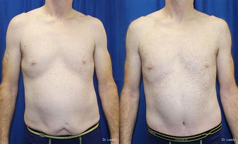 Circumferential Body Lift Before And After Gallery