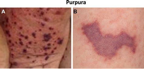 Vascular Disturbances Of The Skin In Critically Ill Patients Chest