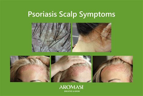 Saltwater Scalp Psoriasis How Does Salt Water Help Treat Psoriasis And
