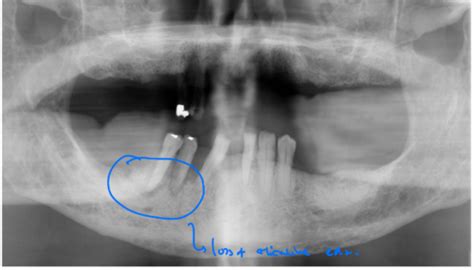 Radiology Of Malignancy Flashcards Quizlet