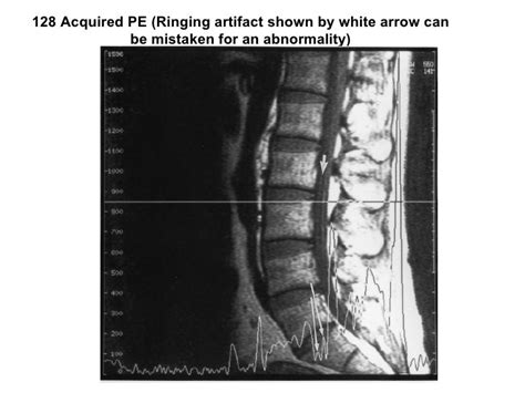 Mri Gibbs Ringing Artifact Reduction