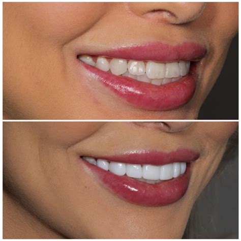 Do Veneers Cause Bad Breath Golden Mile Dental 16474906888