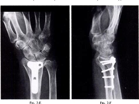 Figure 2 From Open Reduction And Internal Fixation Of Displaced Comminuted Intra Articular