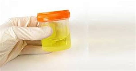 Хоногийн шээснээс уураг тодорхойлох сахар үзэх шинжилгээний төлбөрийг ЭМД ын сангаас 100 хувь