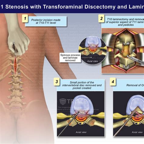 Steroid Injection L5 S1