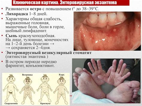Энтеровирусные инфекции вирусы Коксаки и Echo презентация онлайн