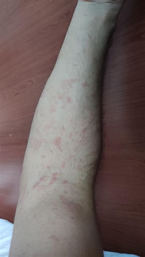 Is This Scabies R Scabies