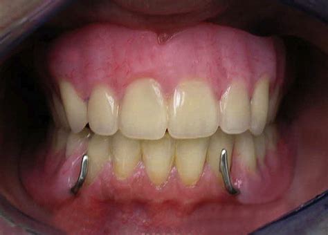 Mandibular Distal Extension Removable Partial Denture At Nancy Grondin Blog