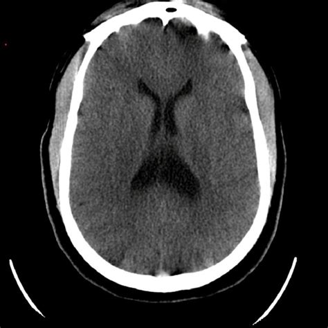 Ct Head Shows A Mild Left Frontal Subcutaneous Soft Tissue Swelling