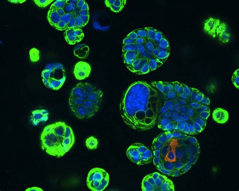 Basal Stem Like Cells Identified As Origin Of Small Cell Lung Cancer In