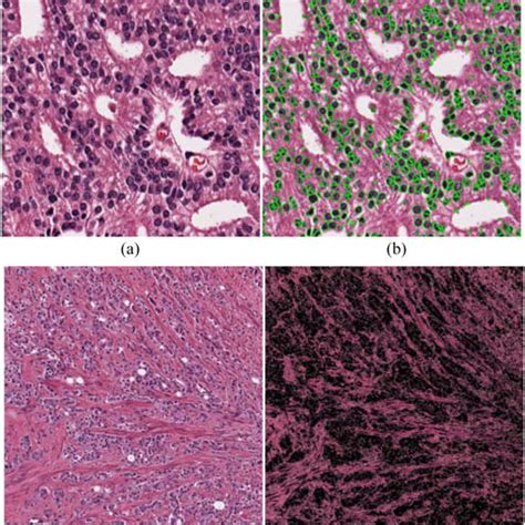 example of nuclei detection and stroma segmentation a original image
