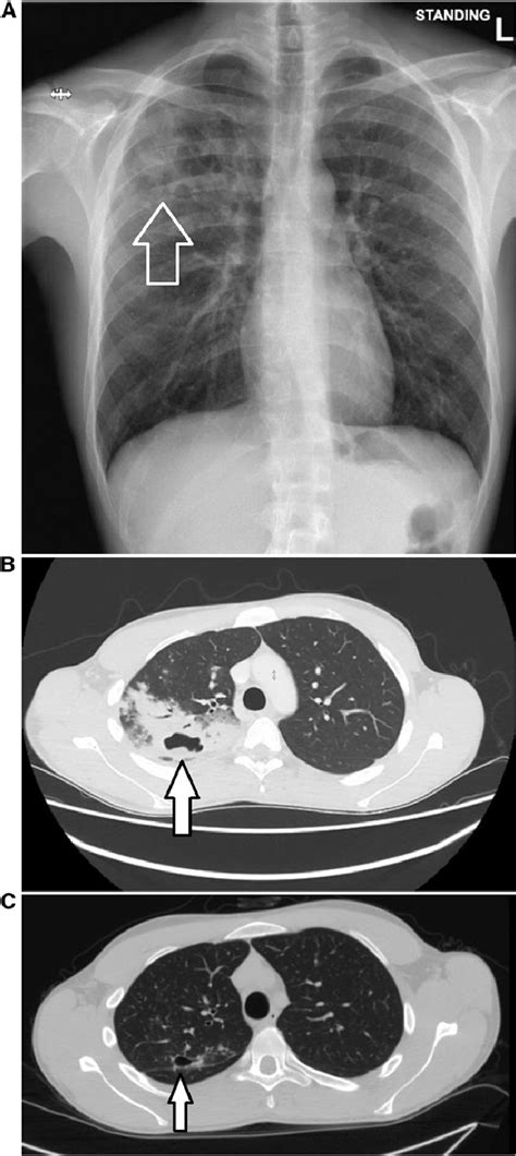 What Is Cavitation On Chest X Ray