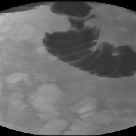 Endoscopic View Of The Duodenal Bulb With The Stricture Download Scientific Diagram