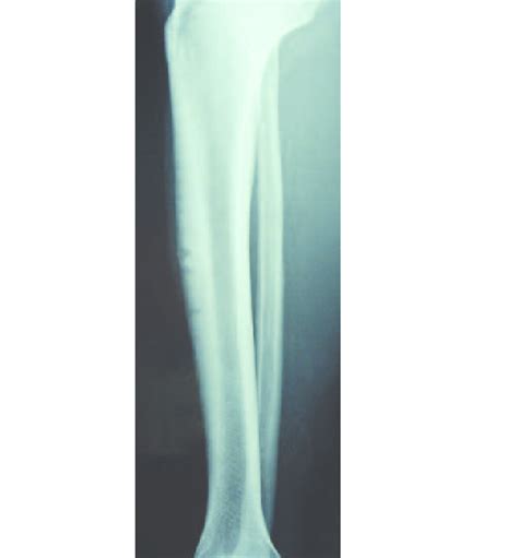 Radiograph Of The Right Tibia Showing Multi Appearance Of The Anterior Download Scientific