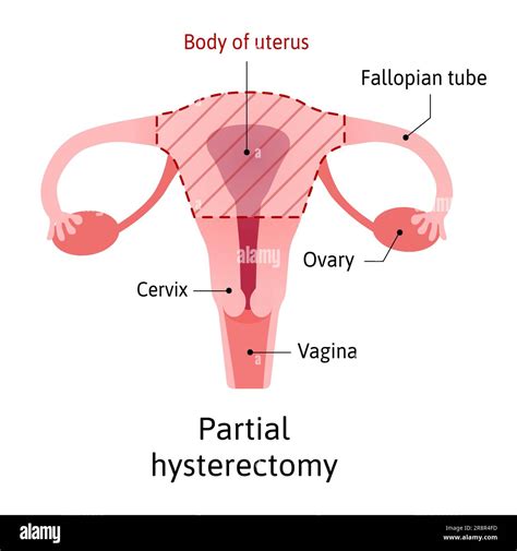 Uterus Radical Hysterectomy Beautiful Cervix Project The Practice Of