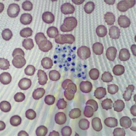 Platelet Clumping Pseudothrombocytopenia Question Classical Hematology