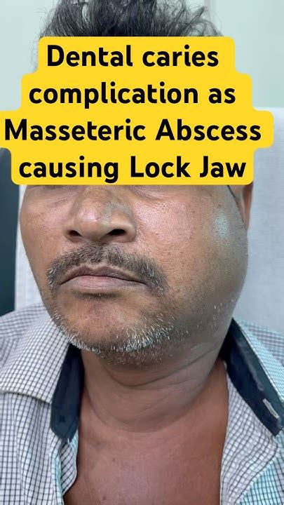 Jaw Abscess In Masseteric Space Causing Trismus Due To Dental Caries