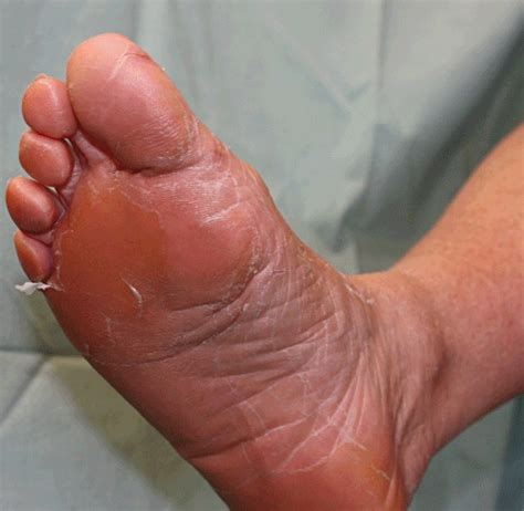 Plantar Keratoderma With Fissuring Download Scientific Diagram