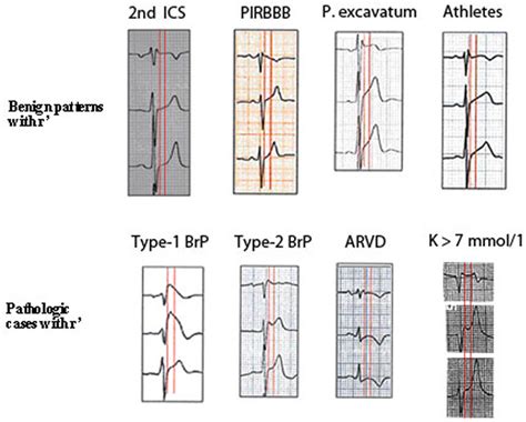 Figure 10 From Differential Diagnosis Of RSr Pattern In Leads V1 V2 Comprehensive Review And