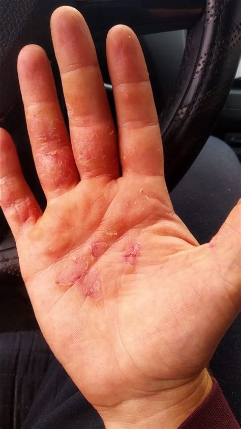 Трескается кожа на пальцах рук причины почему около ногтей портится кожа