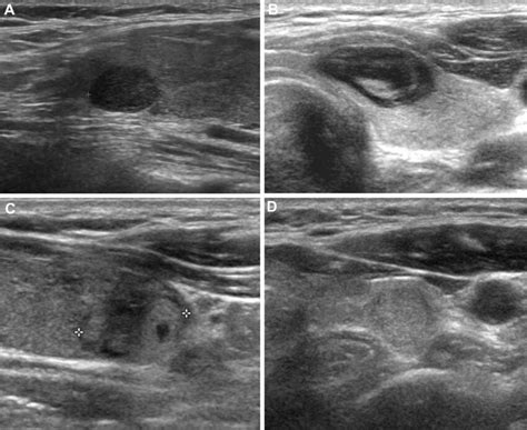 Thyroid Nodules Classified According To The Echotexture And Download Scientific Diagram