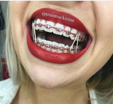 Pin Su Girlwbraces